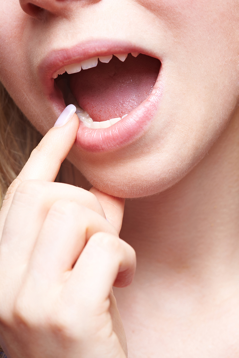 Some Wisdom About Wisdom Teeth | Central Coast Dental Care